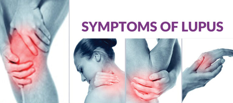 Lupus Treatment & Symptoms - Arthritis and Osteoporosis Associates