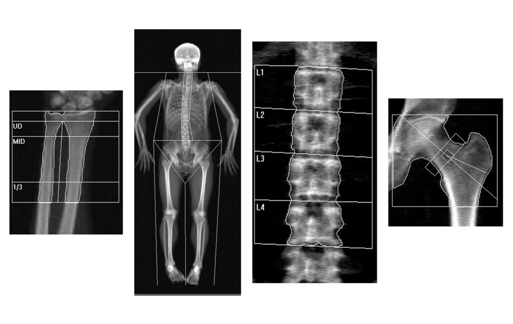 DXA Scan - Arthritis and Osteoporosis Associates